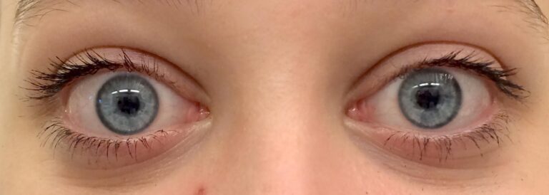 Endokrine Orbitopathie - Dr. Andrea Papp