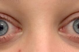 Endokrine Orbitopathie - Dr. Andrea Papp